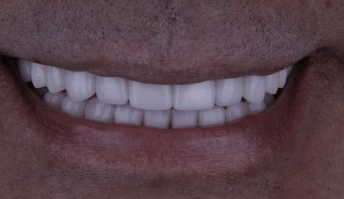 Smile Gallery | Springhetti Dentistry