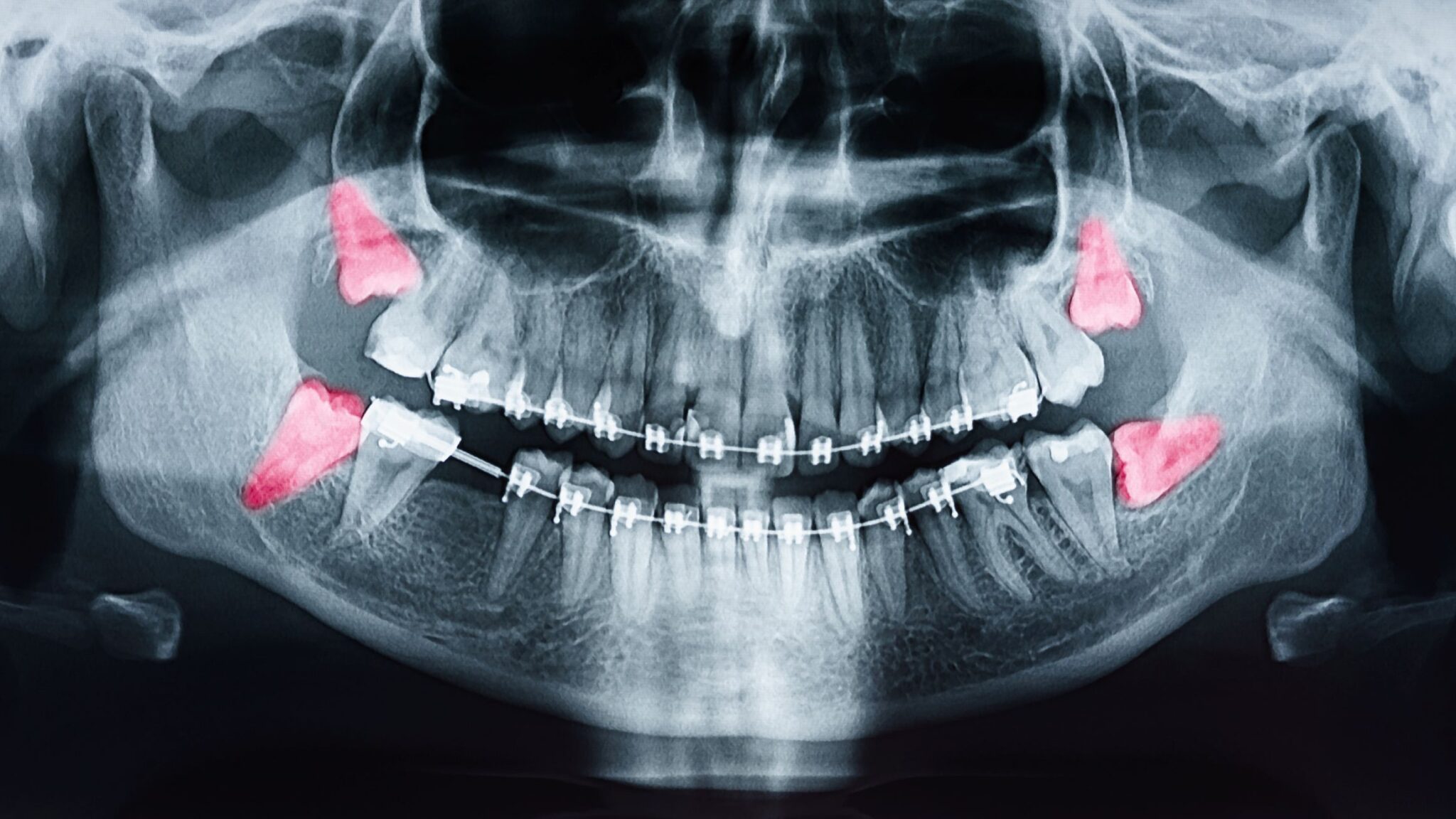 Tooth Tally How Many Wisdom Teeth Do I Have Springhetti Dentistry